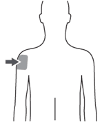 INVEGA TRINZA® (paliperidone palmitate) Administration